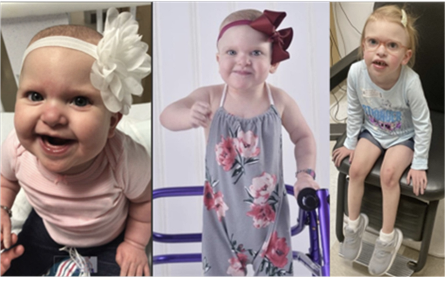 ZEB2 Gene Variants and Mowat-Wilson Syndrome Explained - Mowat-Wilson ...